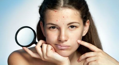 how to prevent acne